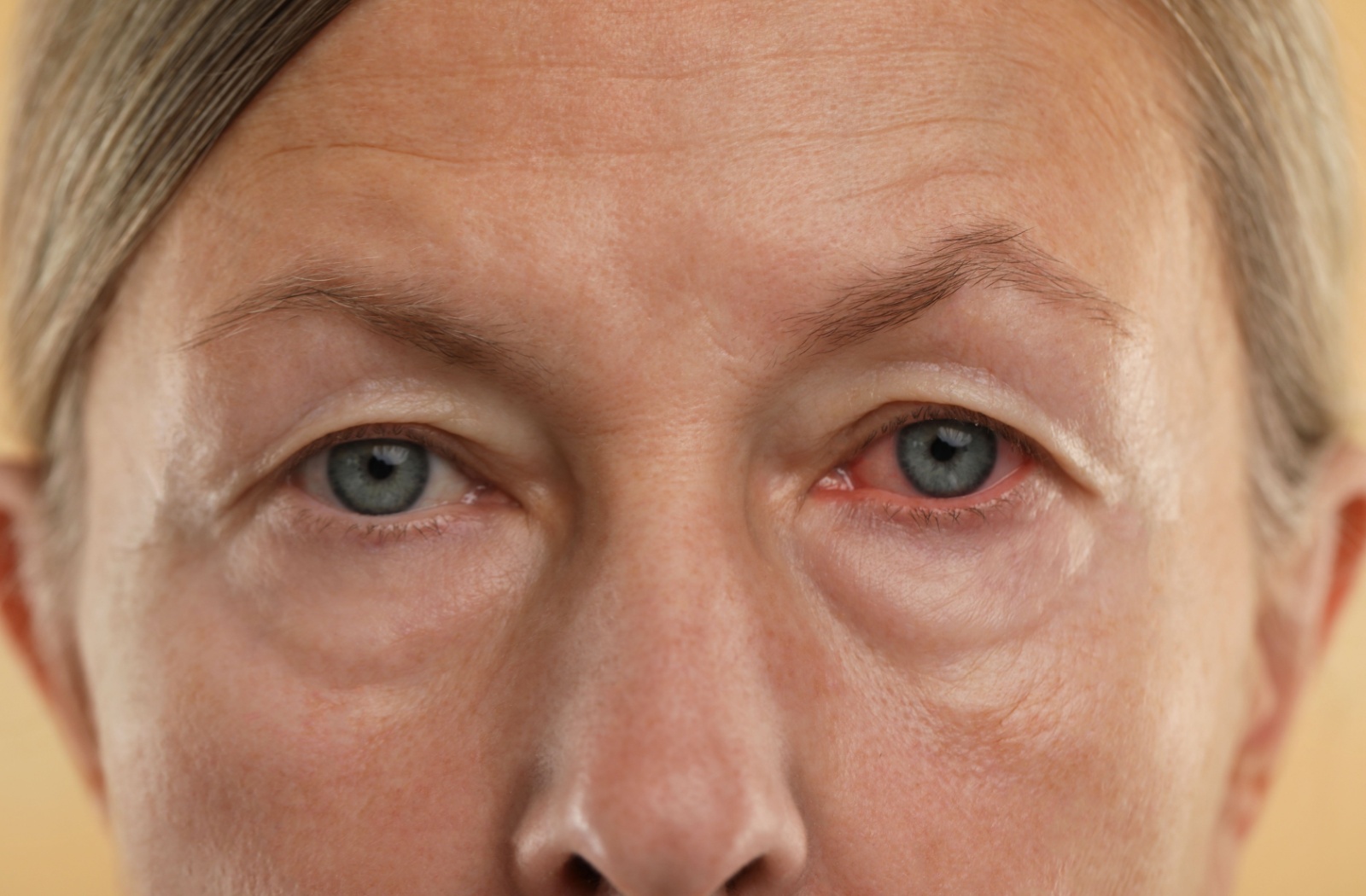 What to Do If You Scratched Your Eye | Novato, CA